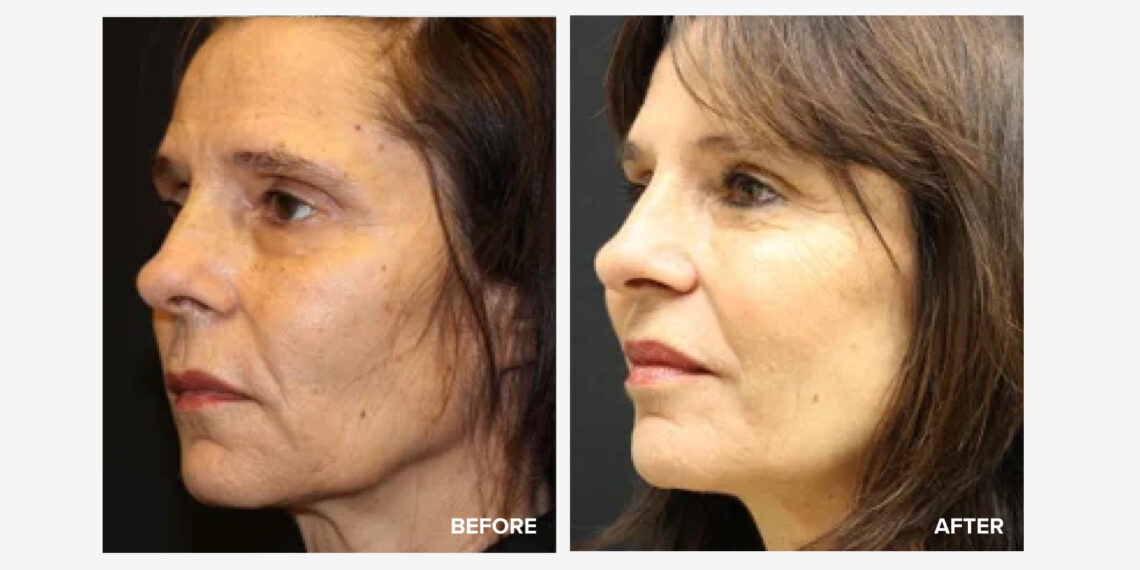 6 Best Sculptra Before and After Photos | RealSelf News
