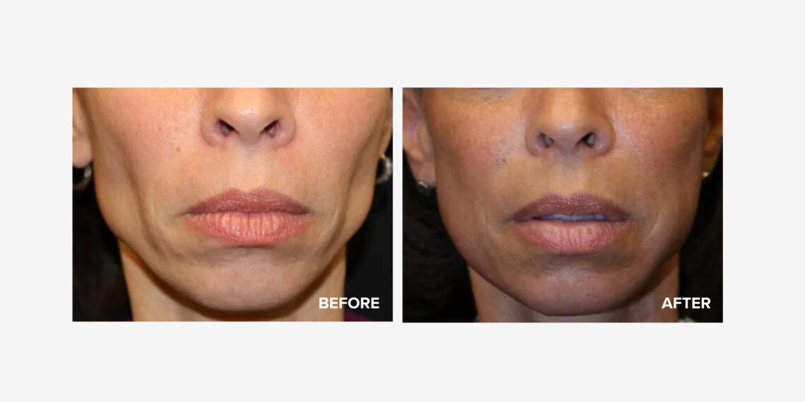 6 Best Sculptra Before and After Photos | RealSelf News