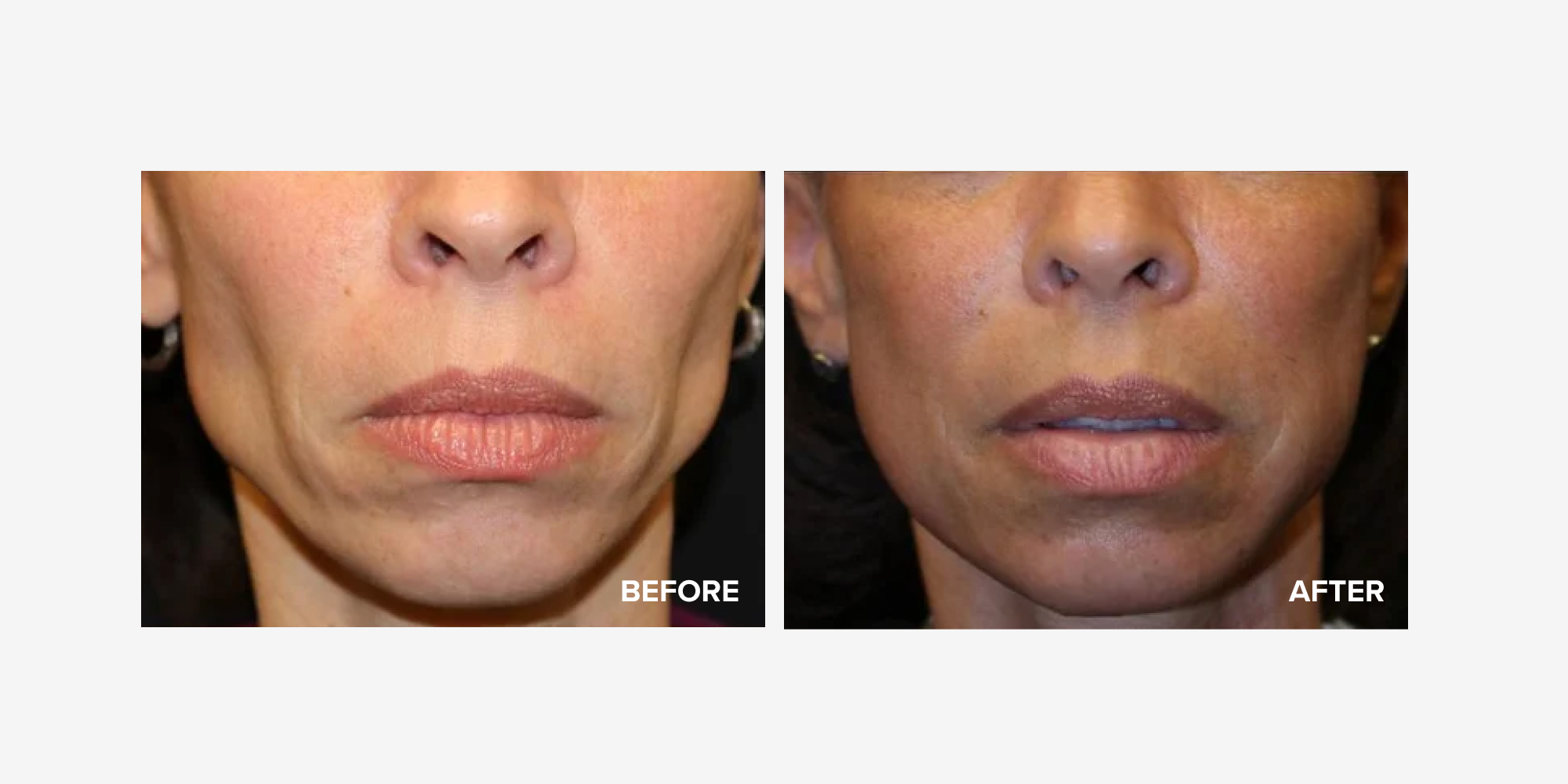 6 Best Sculptra Before and After Photos | RealSelf News