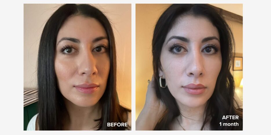 Dana Omari Lip Lift Experience and Results | RealSelf News