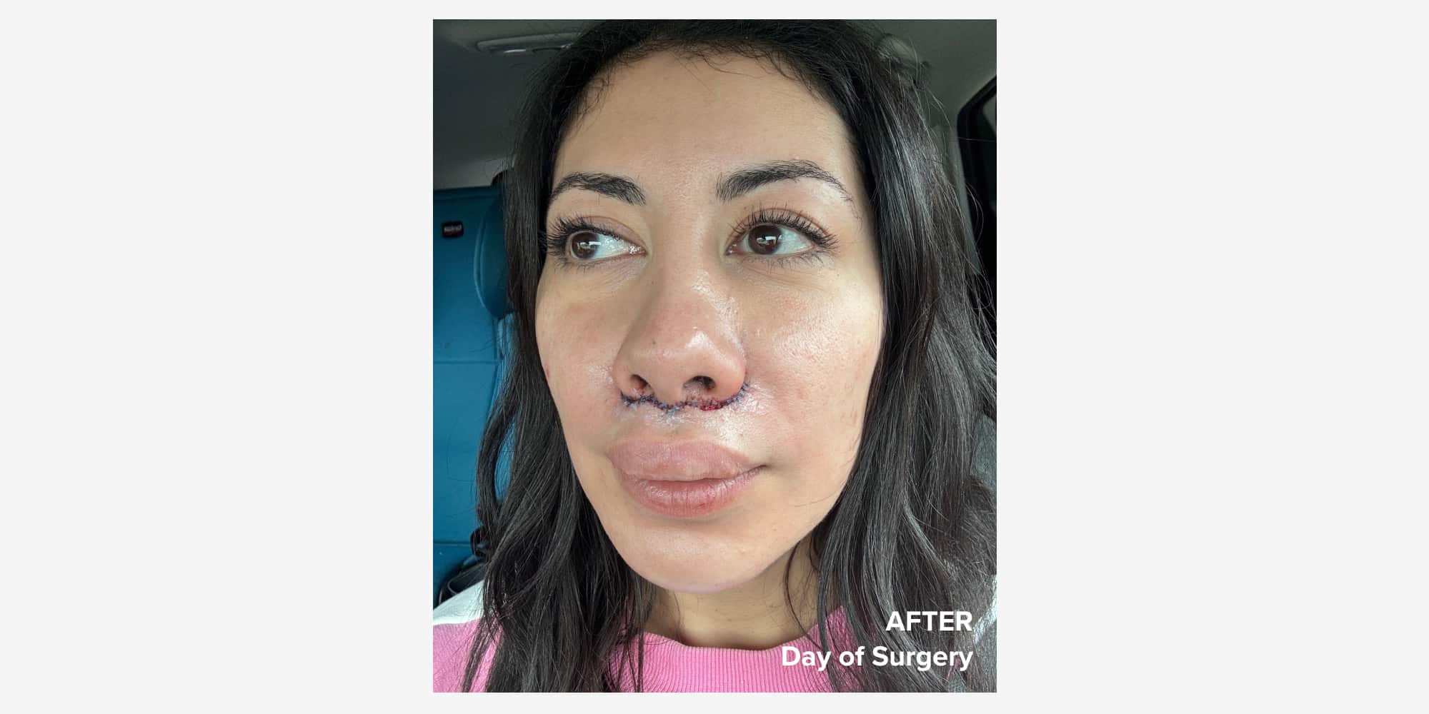 Dana Omari Lip Lift Experience and Results | RealSelf News