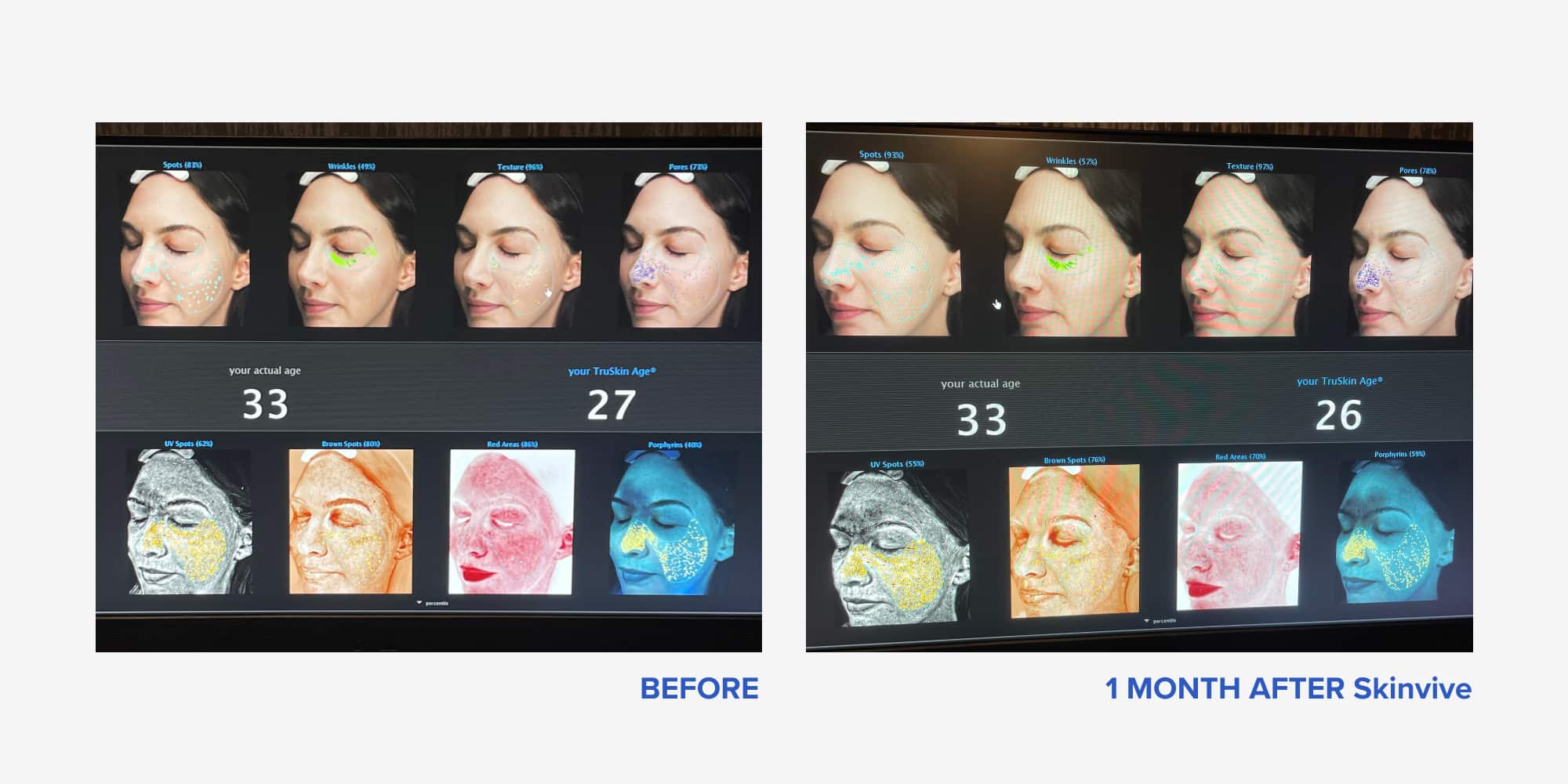 My Skinvive Before-and-After Results | RealSelf News