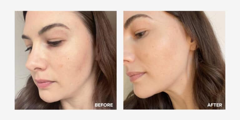 My Skinvive Before-and-After Results | RealSelf News