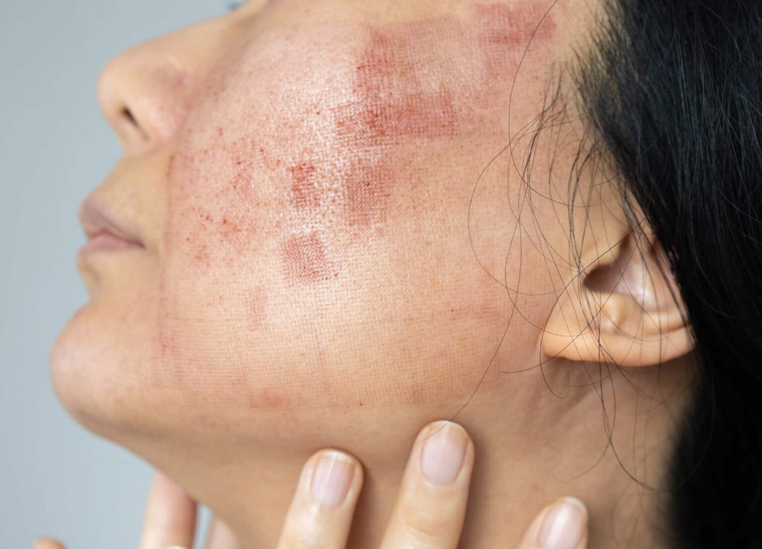 Hypopigmentation: What Causes It and How Is It Treated? | RealSelf News