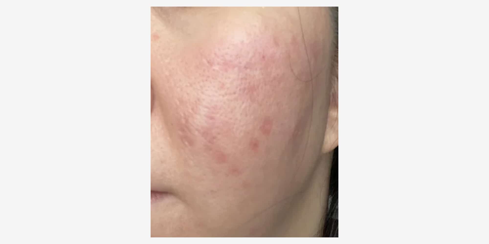 What to Do After a Botched Laser Treatment | RealSelf News