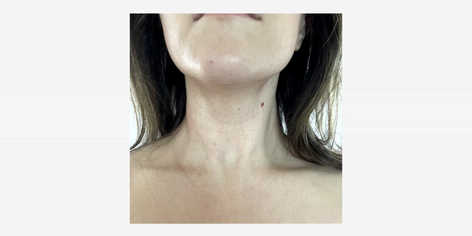 I Got Morpheus8 on My Face & Neck—Here's How It Felt | RealSelf News