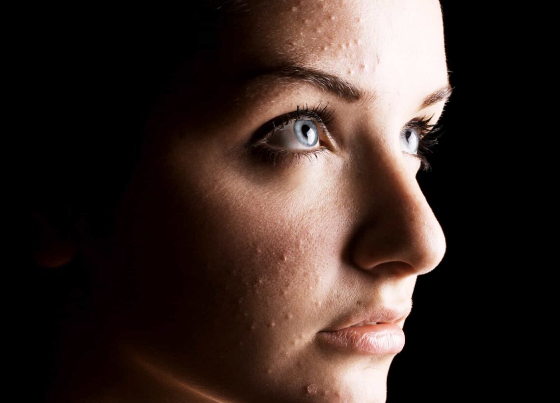 What Is Skin Purging and Treatments That Cause It | RealSelf News