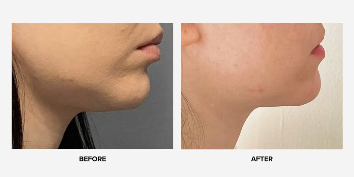 My Genioplasty Results, Recovery & Pain| RealSelf News