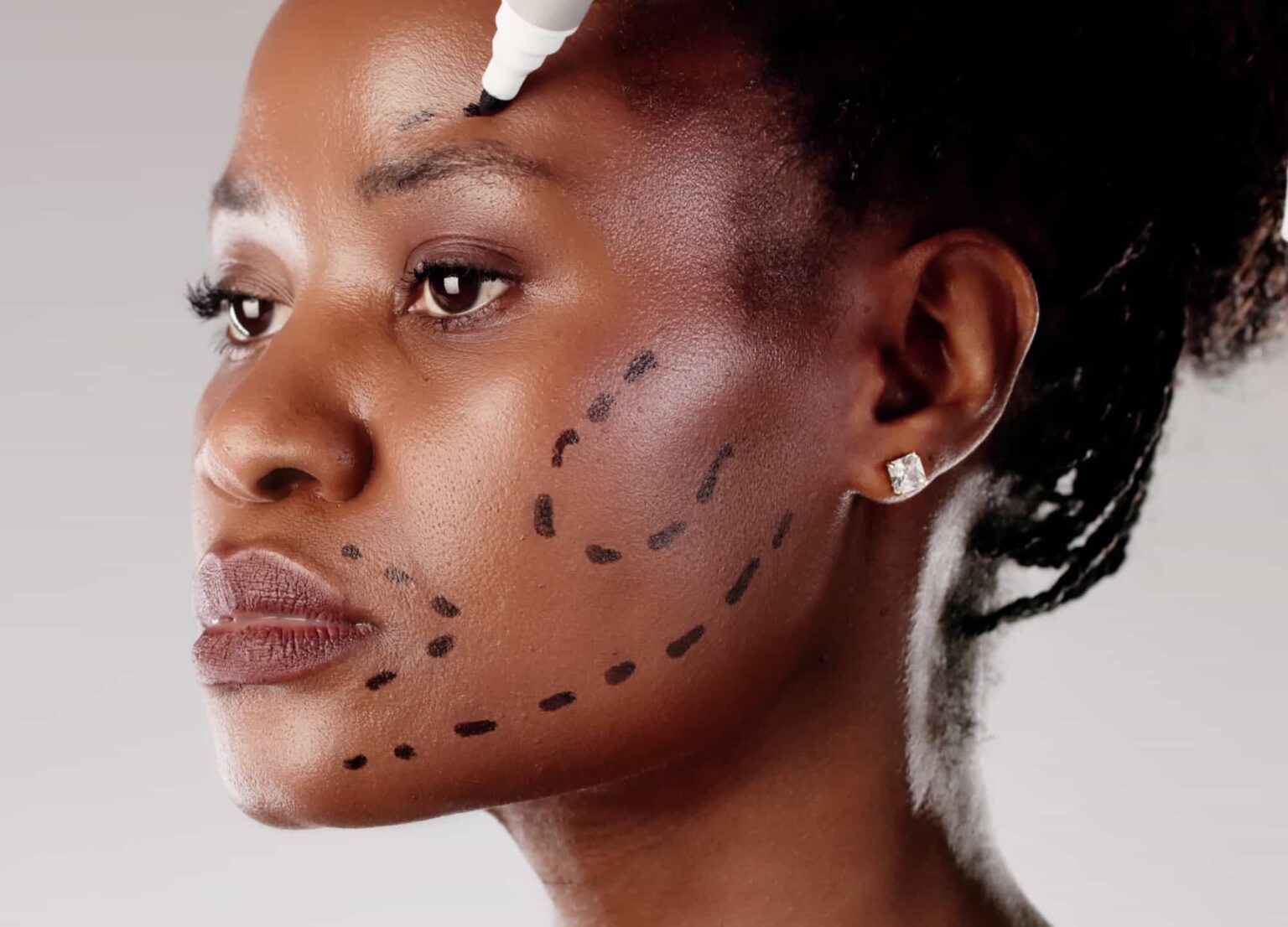 What Real Facelift Scars Look Like on 11 Patients | RealSelf News